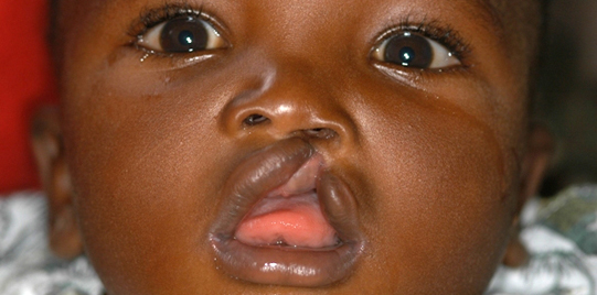 Birth Defects Attorneys Inform about Cleft Lip and Cleft Palate